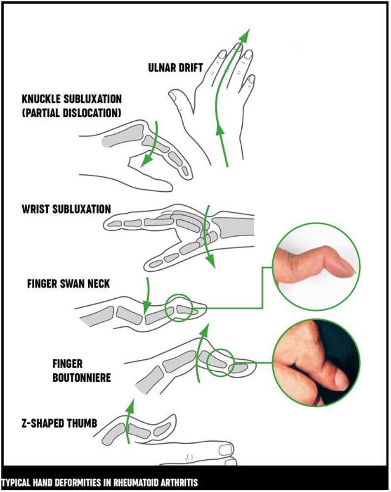 Sterling Silver Thumb Splint Ring, MP Hyperextension Hypermobility ...