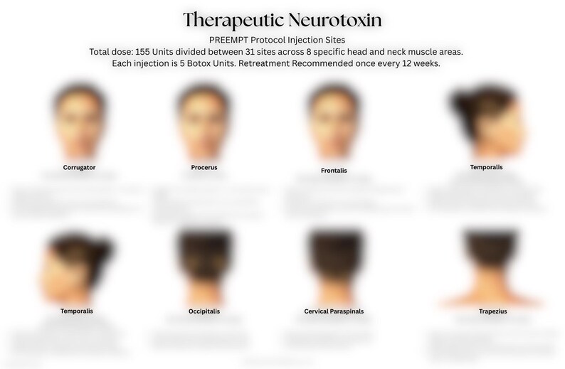 PREEMPT Protocol Injection Sites Chart | Therapeutic Botox Migraine Map ...