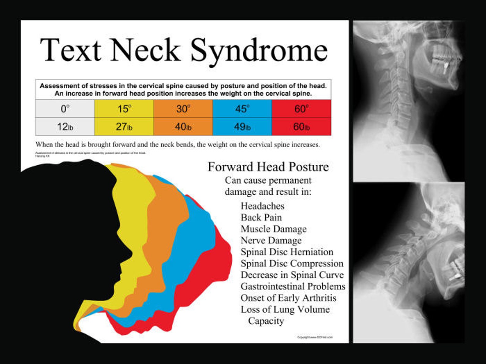 Text Neck Syndrome Poster 18 X 24 Etsy