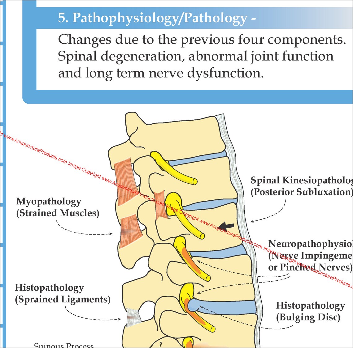 Vertebral Subluxation Complex Spinal Degeneration Poster | Etsy