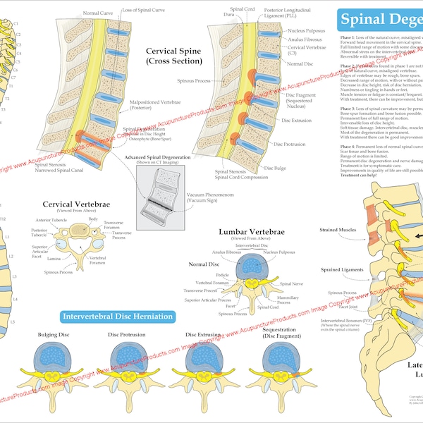 Chiropractic Spinal Degeneration Poster - Etsy