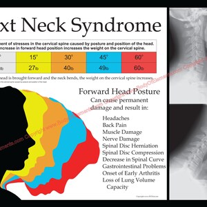 Text Neck Syndrome Pain Poster 18" X 24" Chiropractic Physical Therapy ...