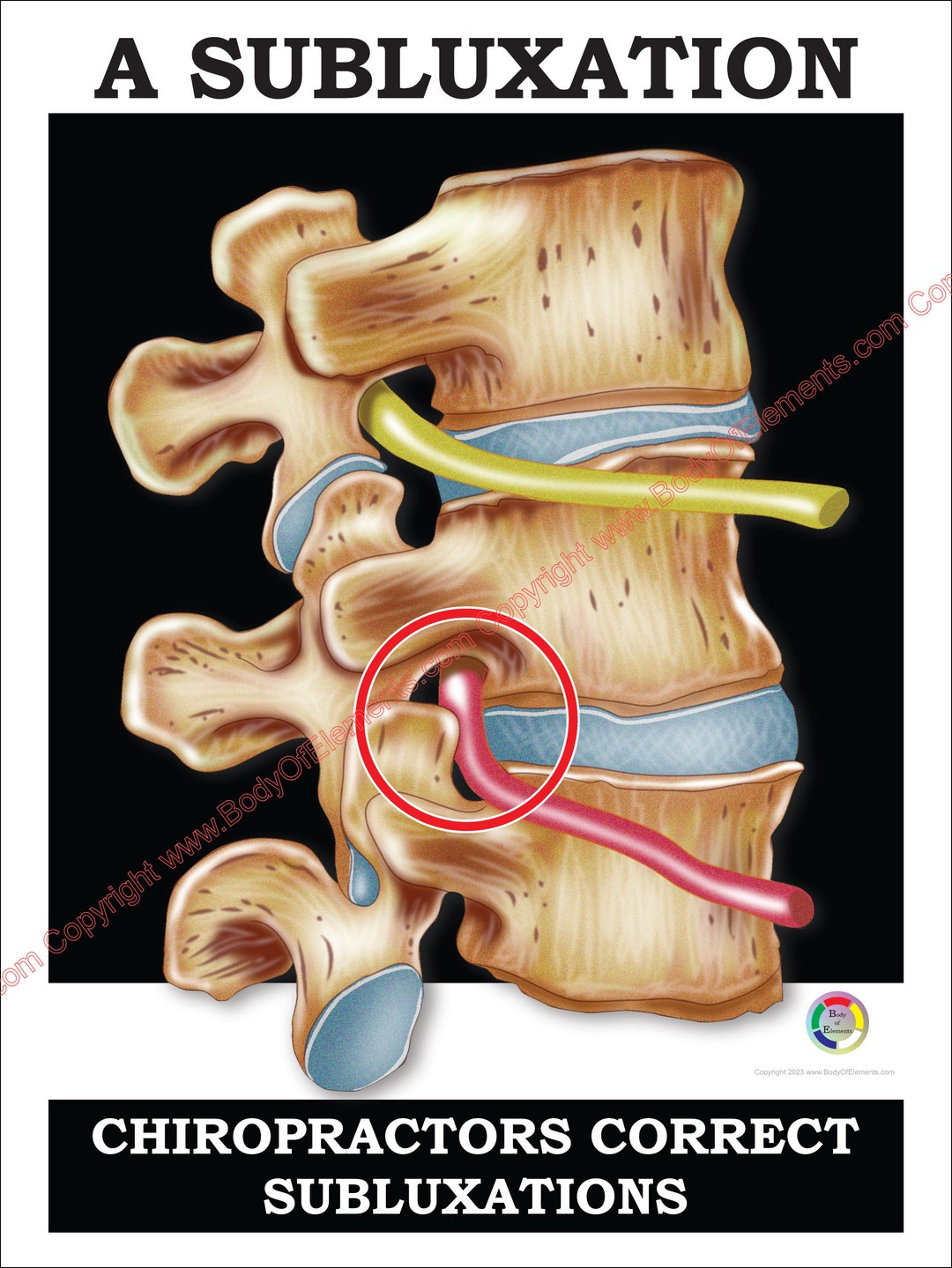 Chiropractors Correct Subluxations Poster 18" X 24" Chiropractic Spinal ...