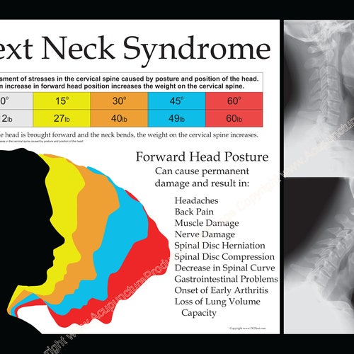 Text Neck Syndrome Pain Poster 18 X 24 - Etsy