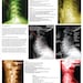 Cervical Vertebral Spinal Disc Degeneration Poster 18" X 24 ...