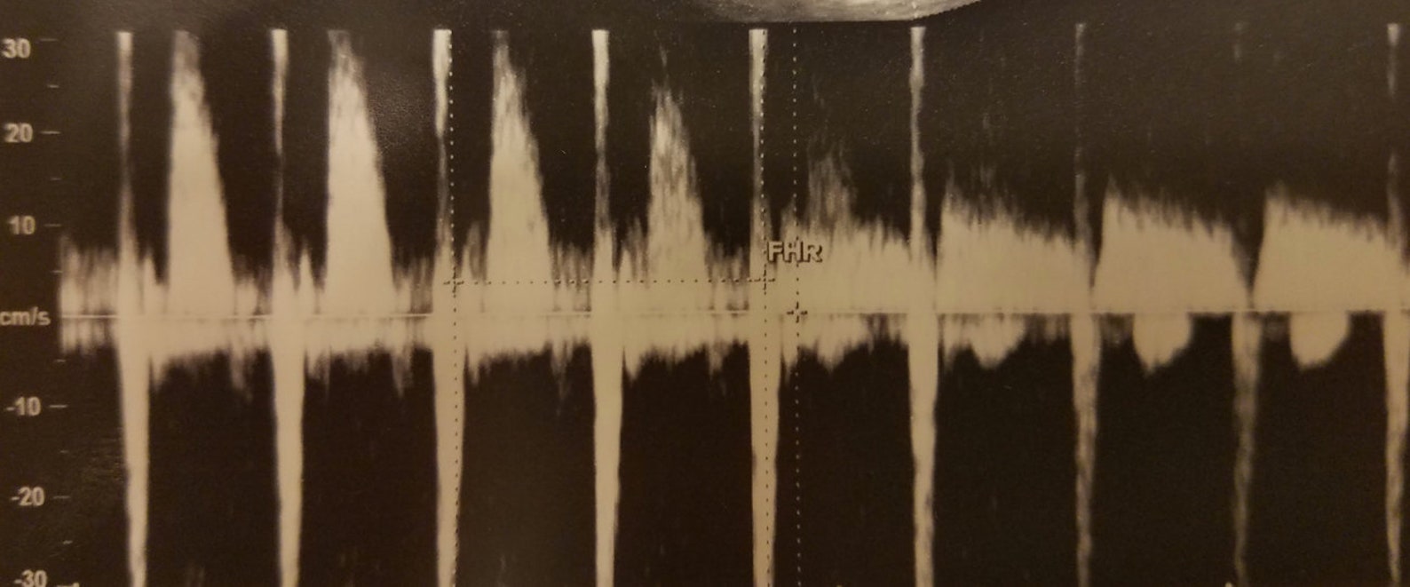 Mini Custom Baby Heartbeat Wood Soundwave Wall Sculpture, Heart Rate ...