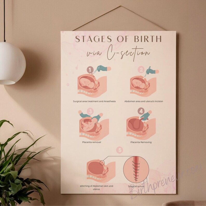 C-section Recovery & Birth Plan Printable Bundle | Postpartum Exercise ...