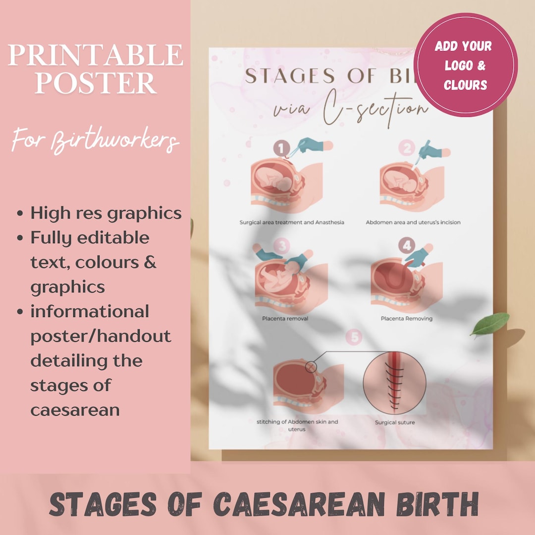 Stages of C-section Birth Education Poster | Doula Student Midwife ...