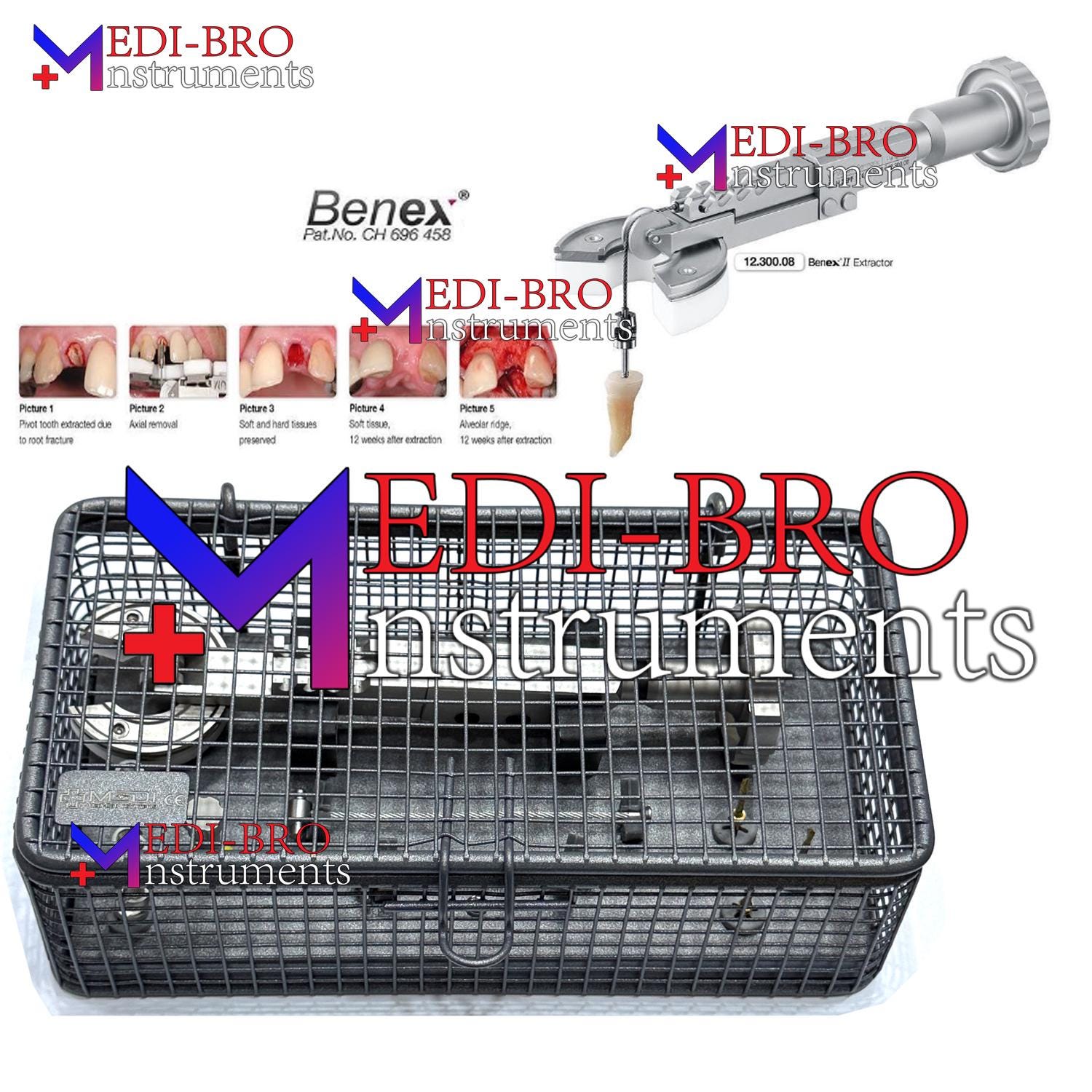 BENEX II Extraction System Full Kit for Tooth Removal - Etsy
