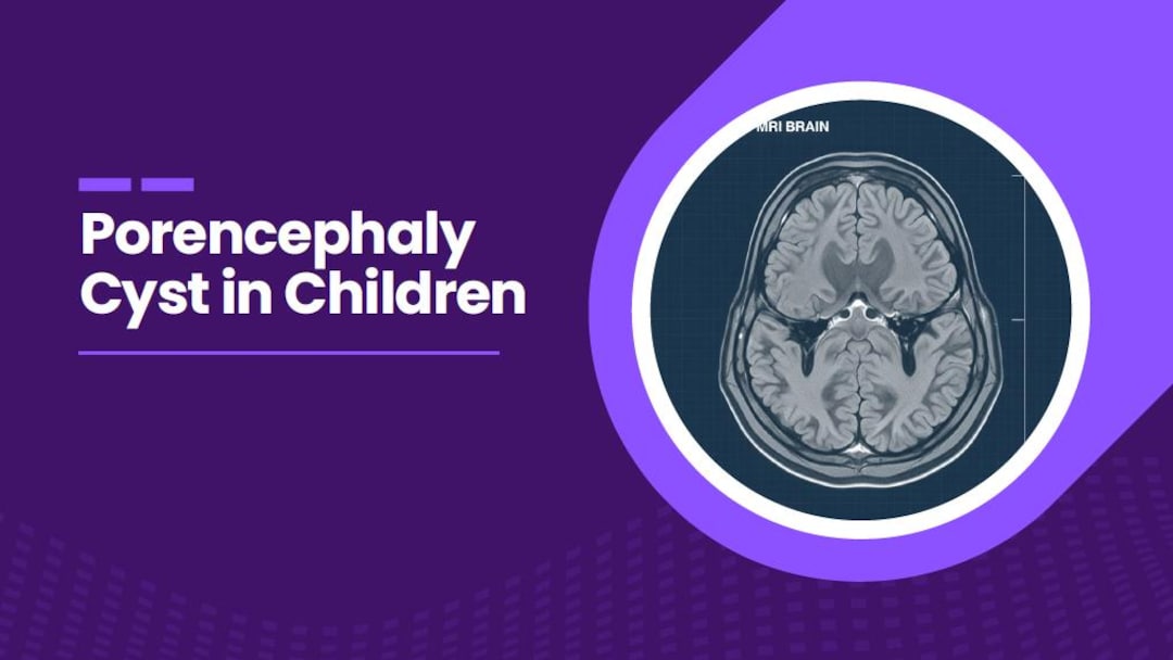 Porencephaly Cyst in Children – Educational Medical Slide (PDF) - Etsy
