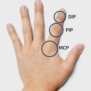 Arthritis Thumb MCP Splint Yellow Bronze, EDS Splint Ring - Etsy