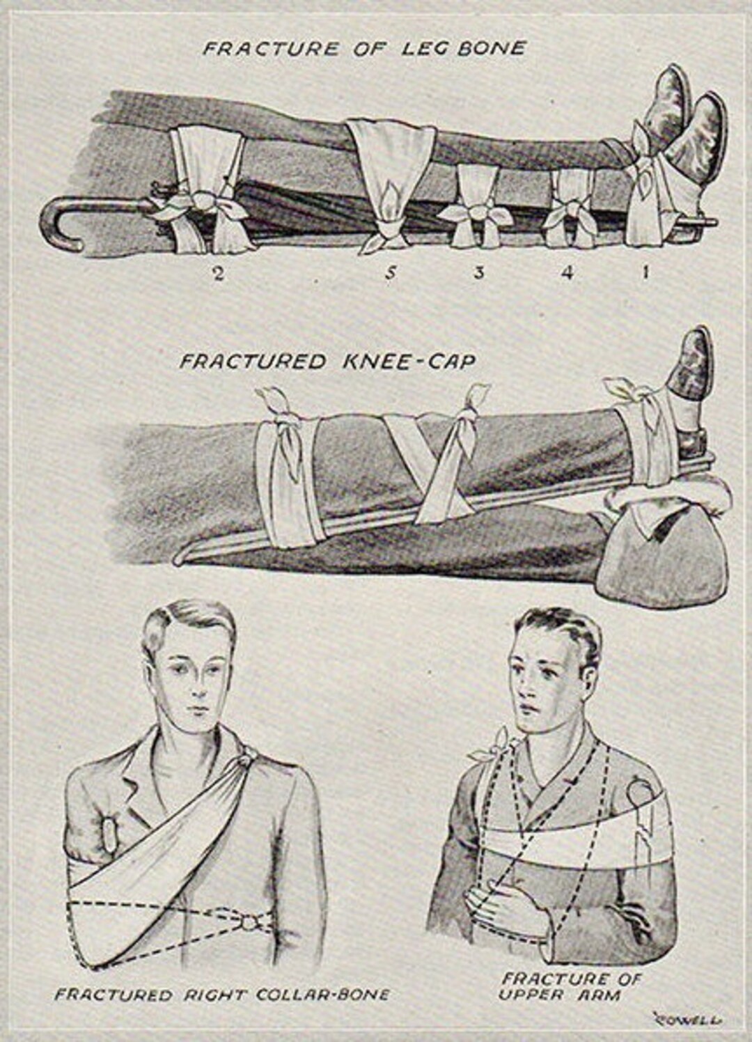 Antique Art Print, First Aid for Broken Bones, Medical First Aid Chart ...