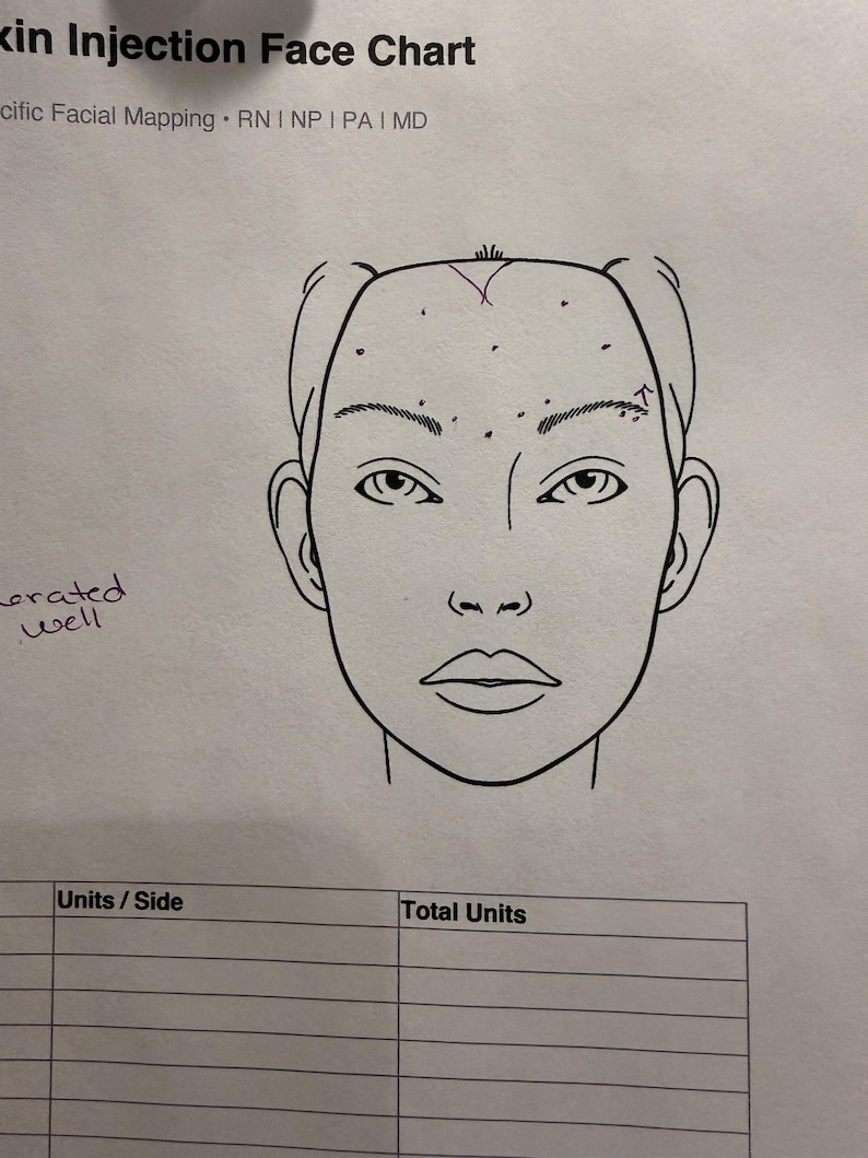 Neurotoxin Injection Face Chart | Patient Facial Mapping PDF | Botox ...