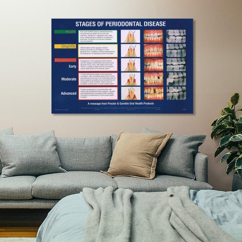 Periodontal Disease Stages Canvas Poster, Dental Clinic Wall Art - Etsy