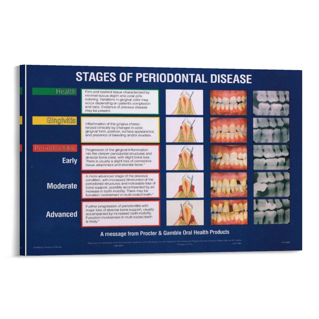 Periodontal Disease Stages Canvas Poster, Dental Clinic Wall Art - Etsy