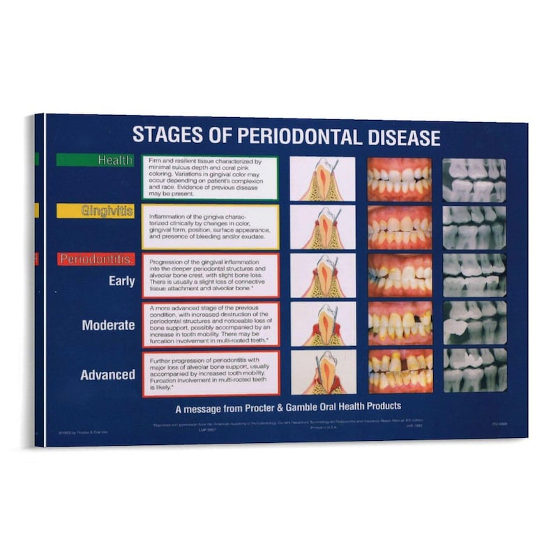 Tooth Periodontal Poster - Etsy