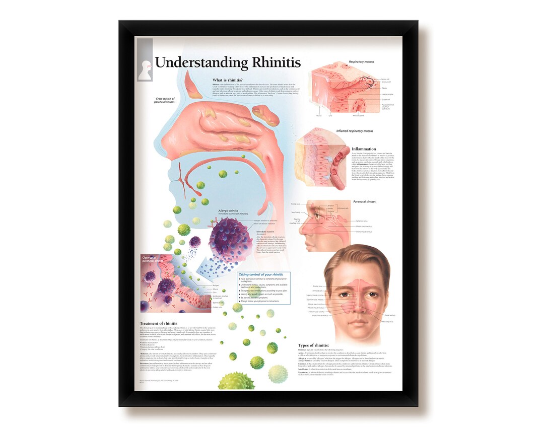 Understanding Rhinitis Framed Medical Educational Poster Informational ...
