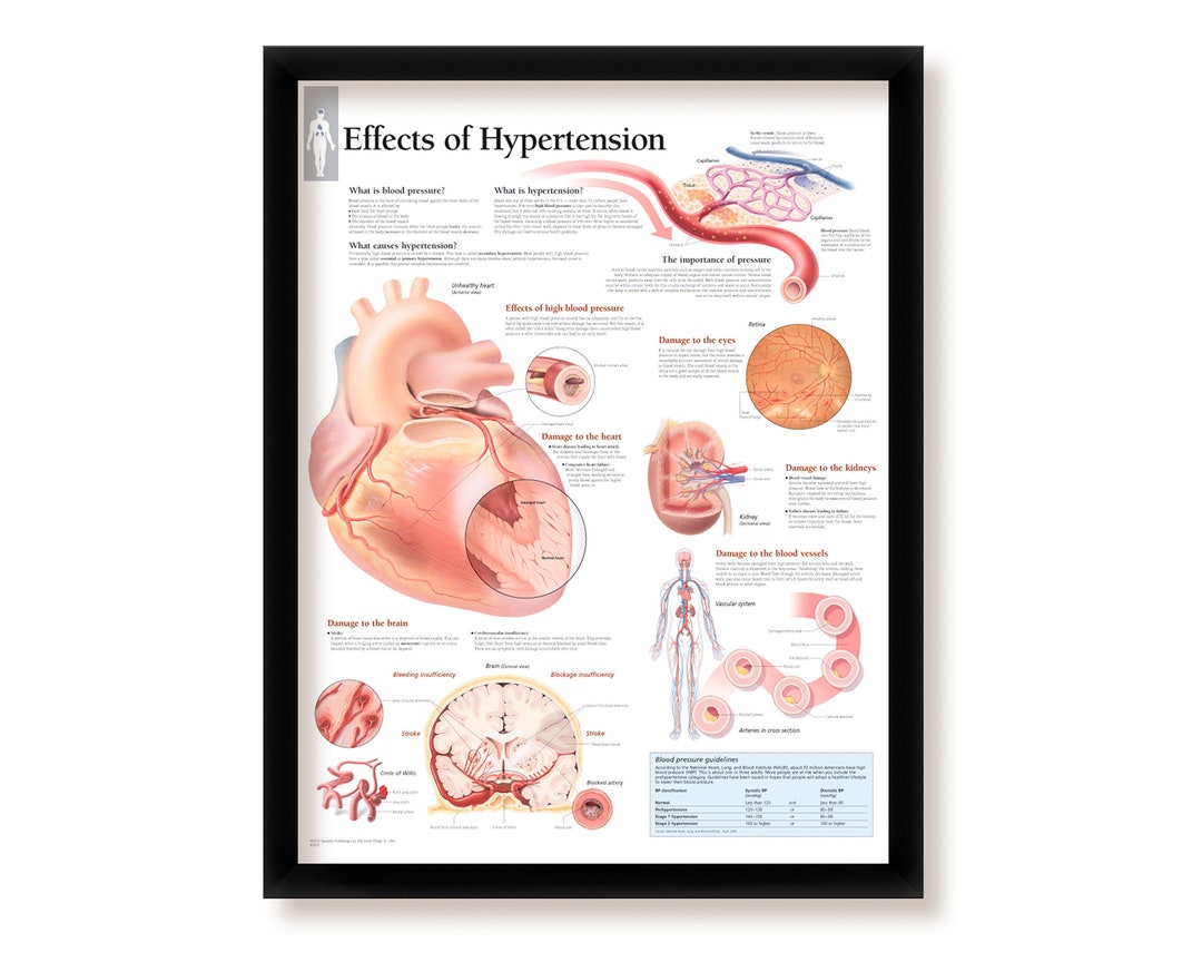 Hypertension Effects Framed Poster | Medical Education Diagram (22x28 ...