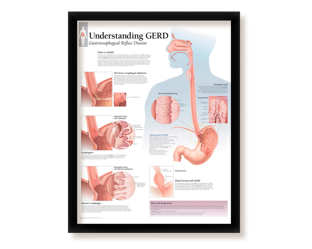 Understanding GERD Framed Medical Educational Informational Poster ...