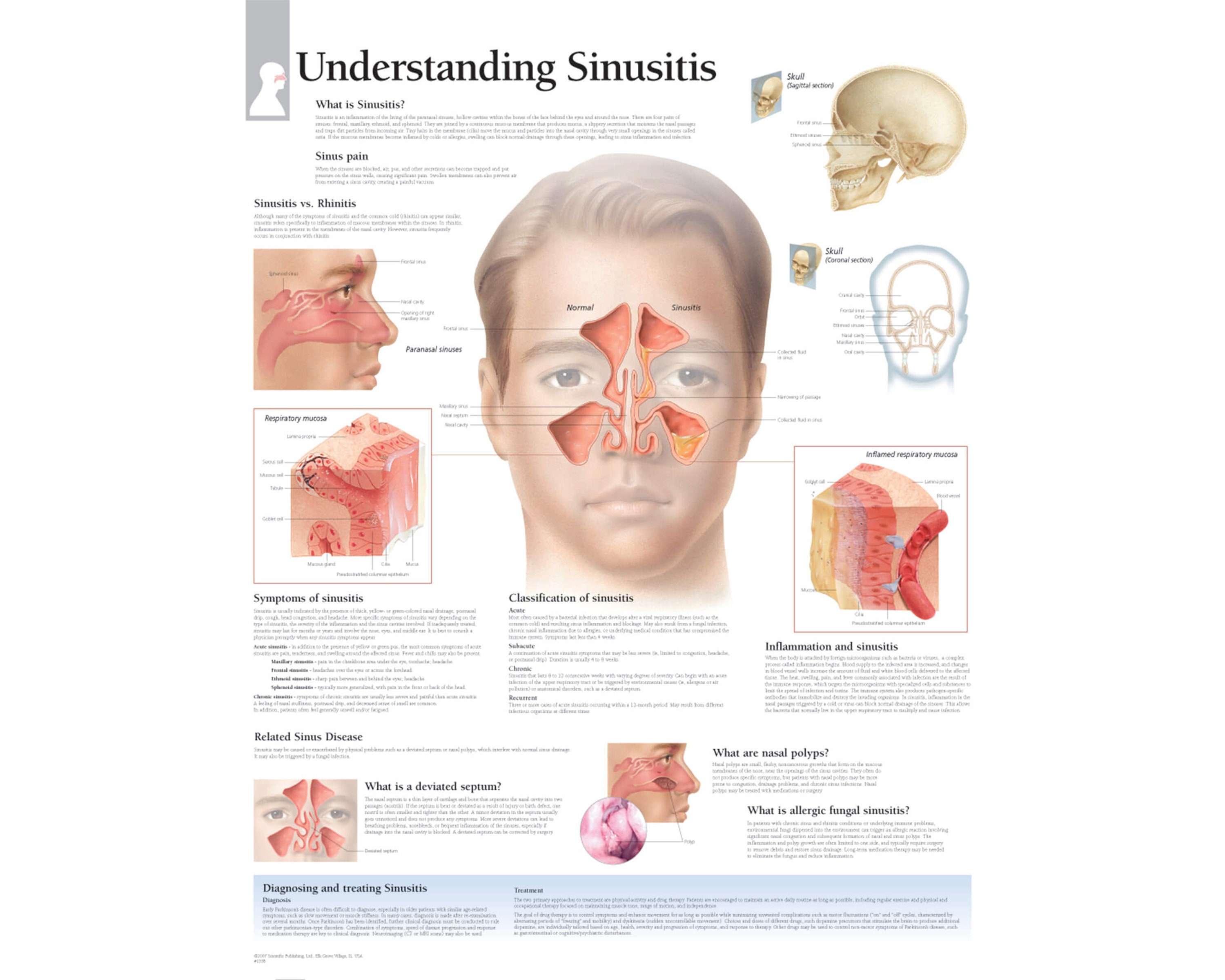 Understanding Sinusitis Medical Educational Informational Poster ...