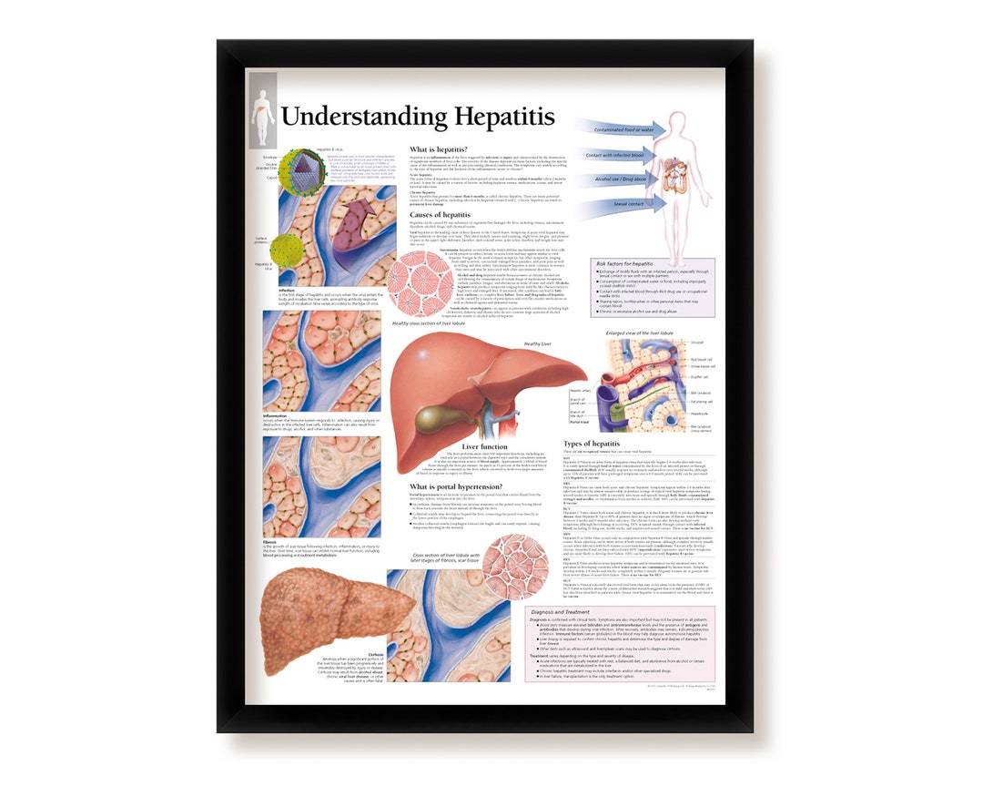 Understanding Hepatitis Medical Poster Educational Informational ...