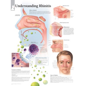 Understanding Rhinitis Framed Medical Educational Poster Informational ...
