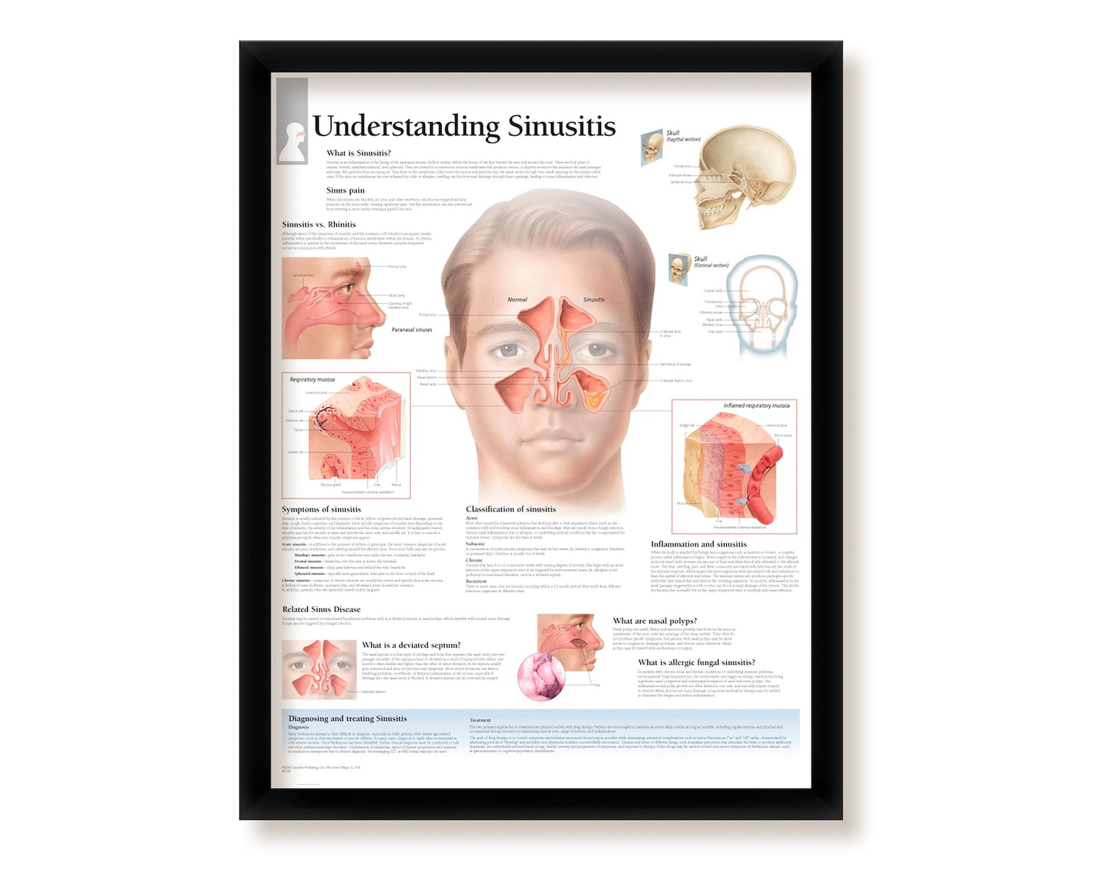 Understanding Sinusitis Medical Educational Informational Poster ...