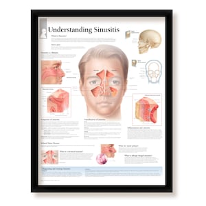 Understanding Sinusitis Medical Educational Informational Poster ...