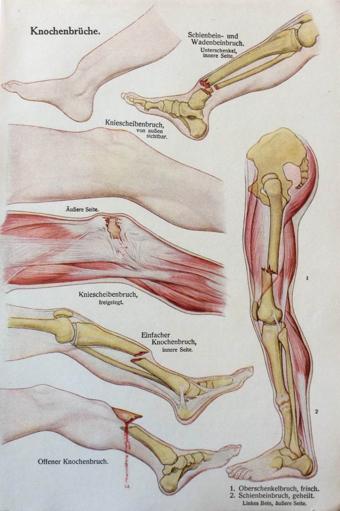 Vintage 1920s German Medical Anatomy BONE FRACTURES Broken Bones ...