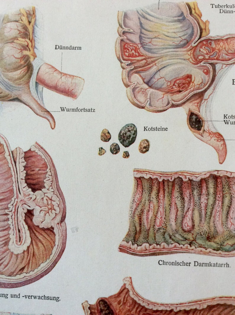 Antique Print 1920s German Medical Anatomy Organs INTESTINAL DISEASES ...