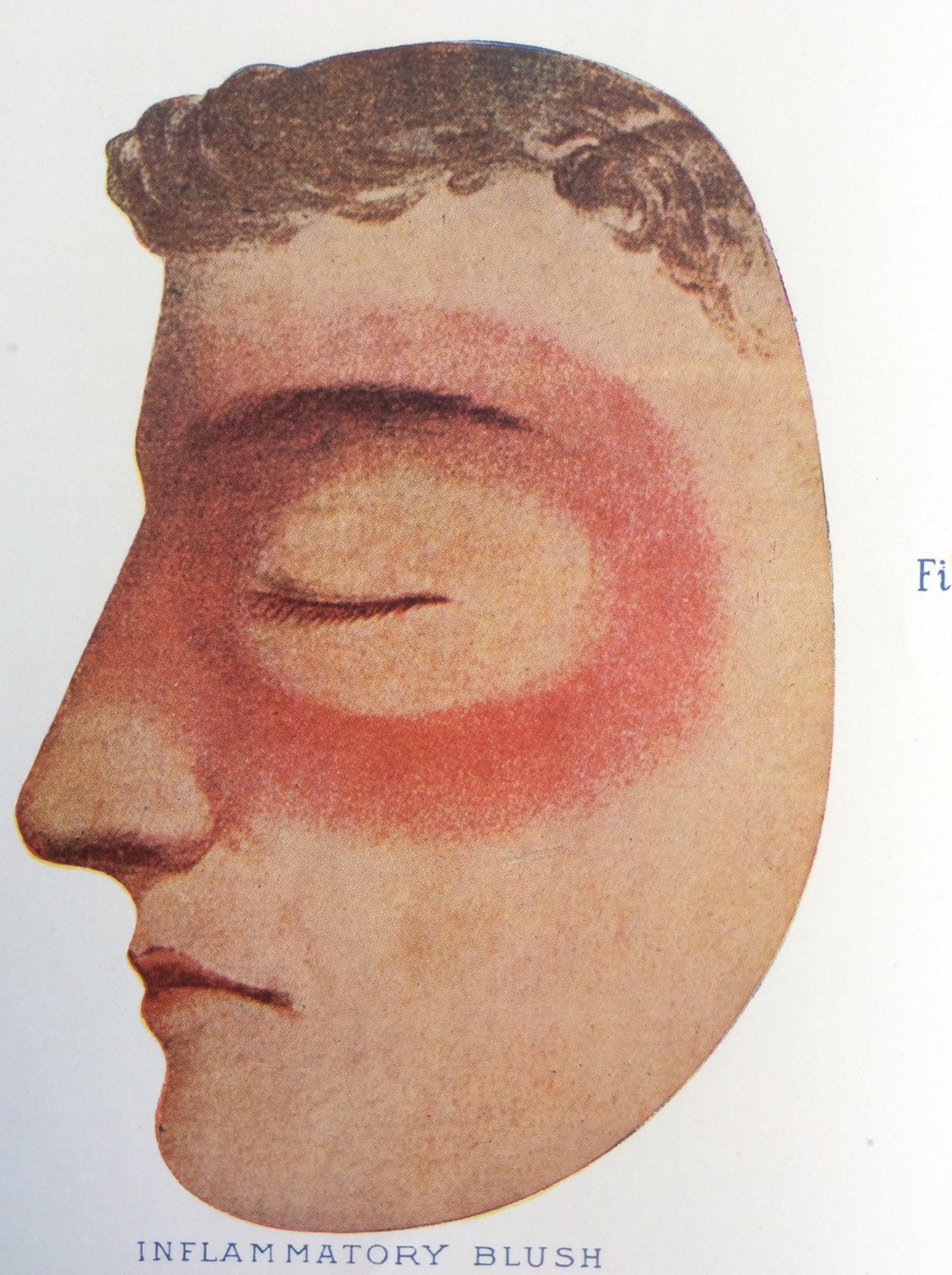 Vintage 1920s Medical Bookplate Print Diagnostic Diagram Erysipelas ...