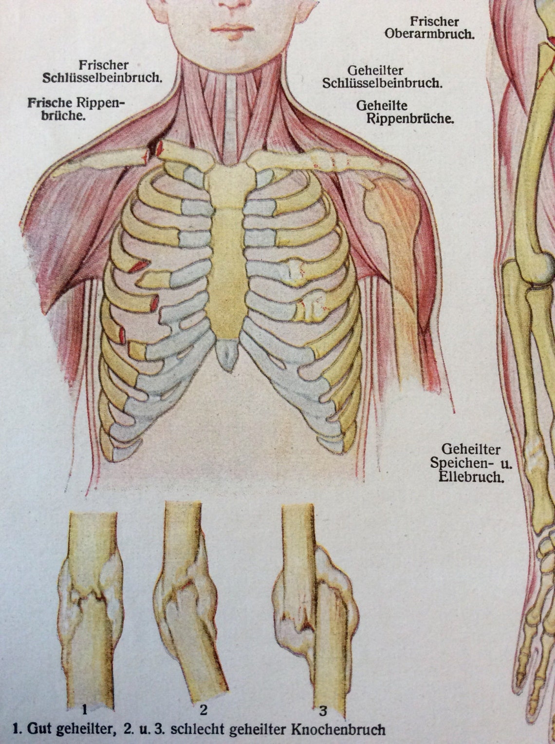 Vintage 1920s German Medical Anatomy BONE FRACTURES SKELETON - Etsy