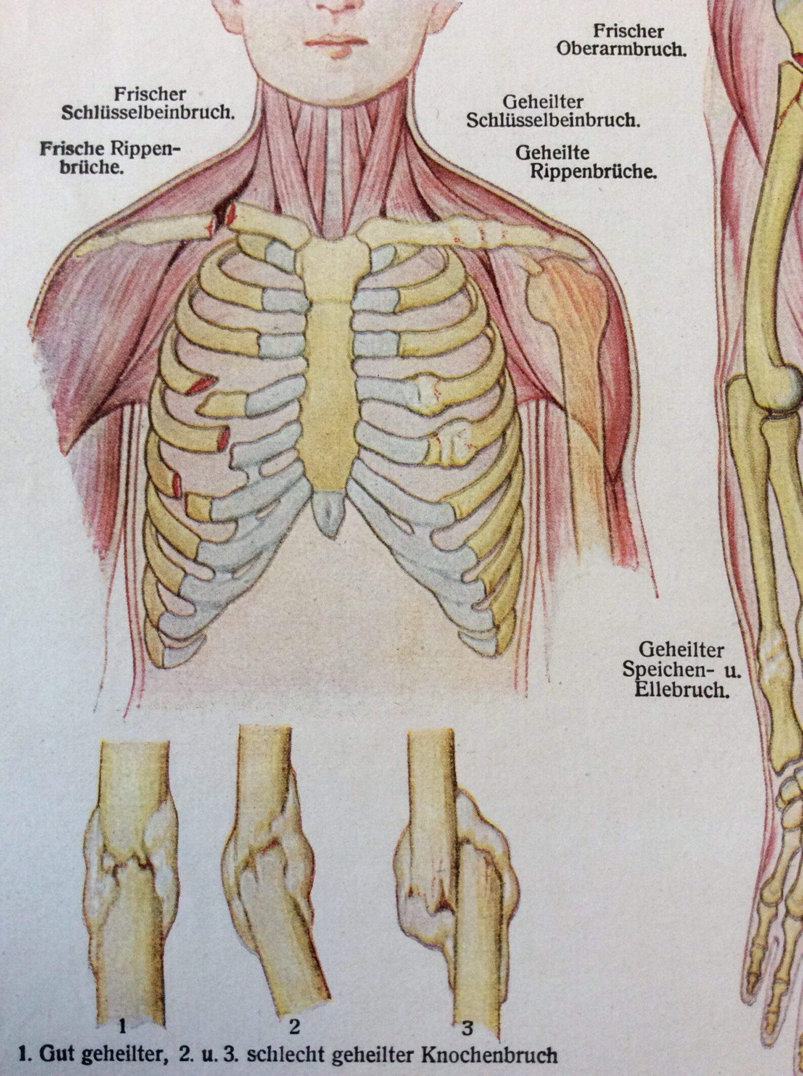 Vintage 1920s German Medical Anatomy BONE FRACTURES SKELETON - Etsy