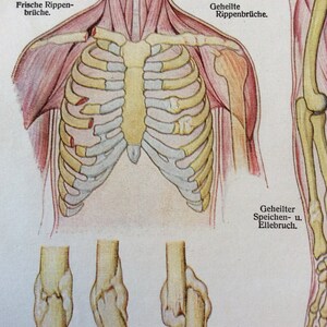Vintage 1920s German Medical Anatomy BONE FRACTURES SKELETON Skull ...