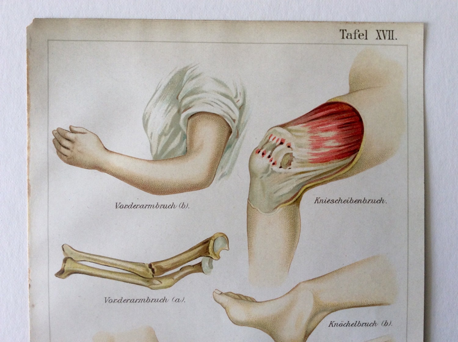 Vintage 1907 German MUSCLE BONE FRACTURE Medical Chromolithograph ...