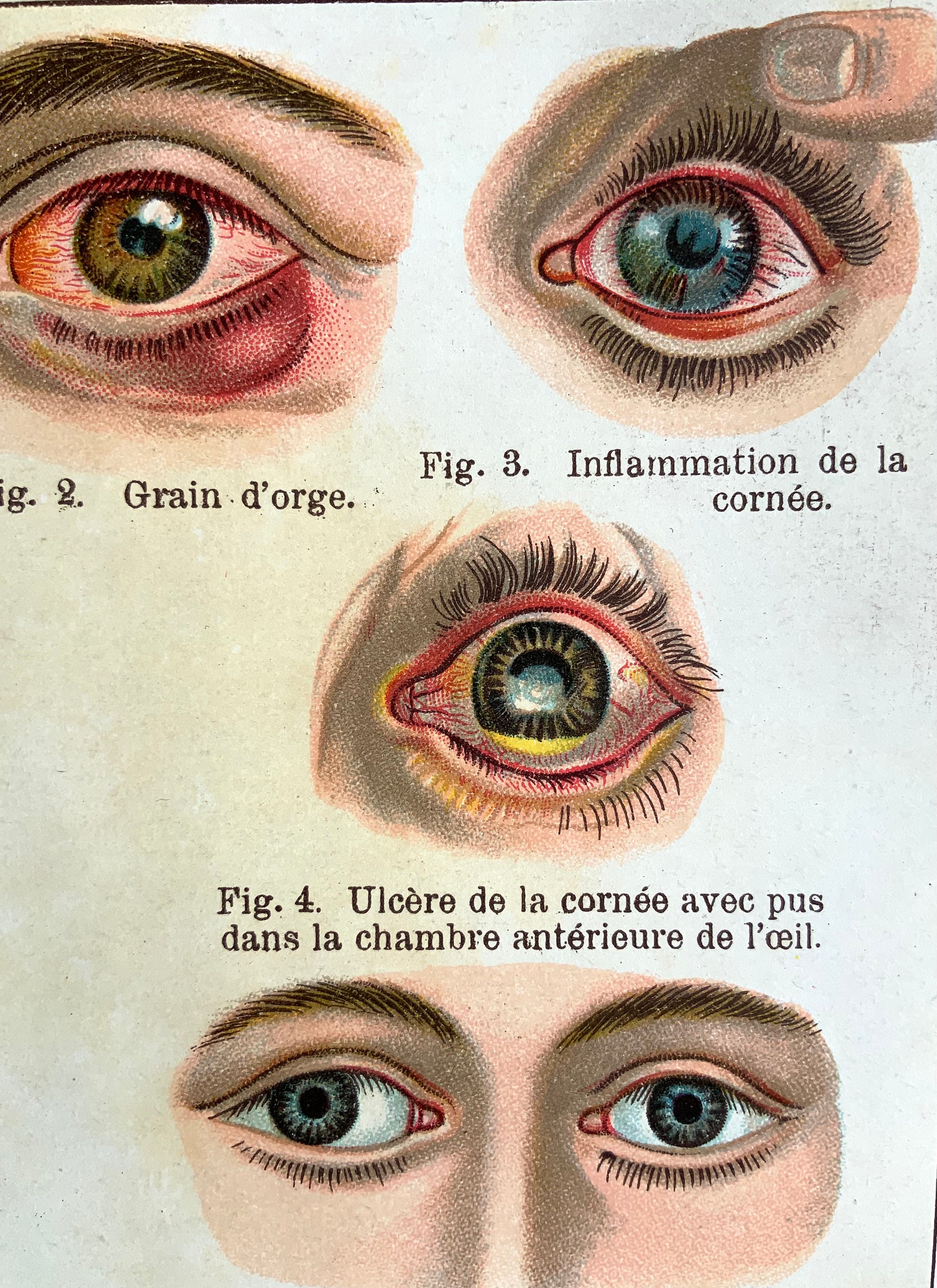 Antique BOSS-EYED Print French Anatomy Bookplate Circa 1900 - Etsy