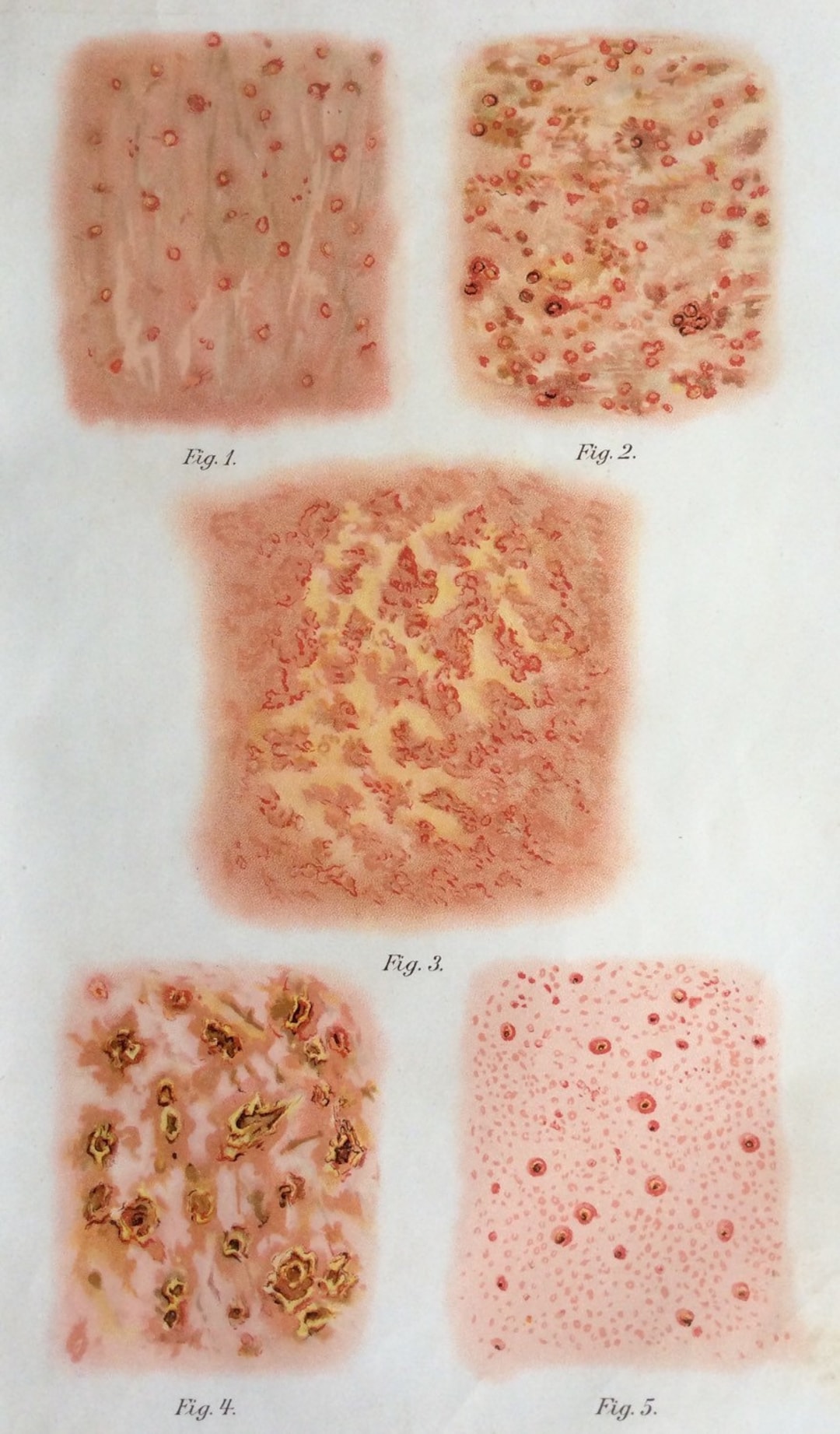 Vintage 1907 German Medical Anatomy Diagram Bookplate Skin Disease ...
