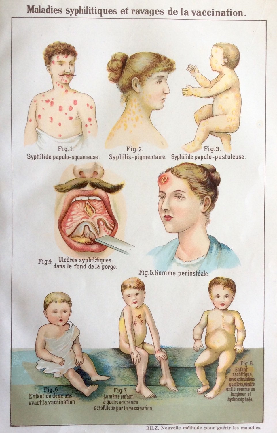 Antique Print French Bookplate Print 1900s Syphilis Chromolithograph Victorian Vintage Medical