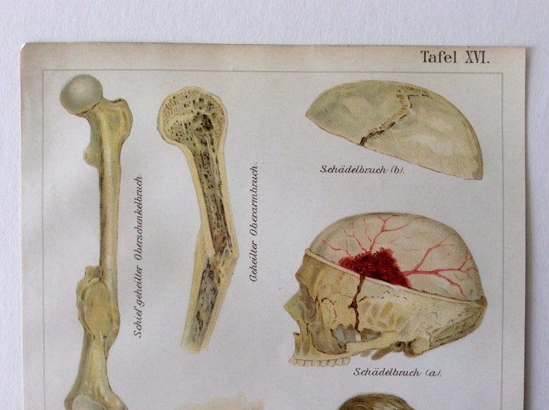 Antique Print 1907 German MUSCLE BONE FRACTURE Medical Chromolithograph ...