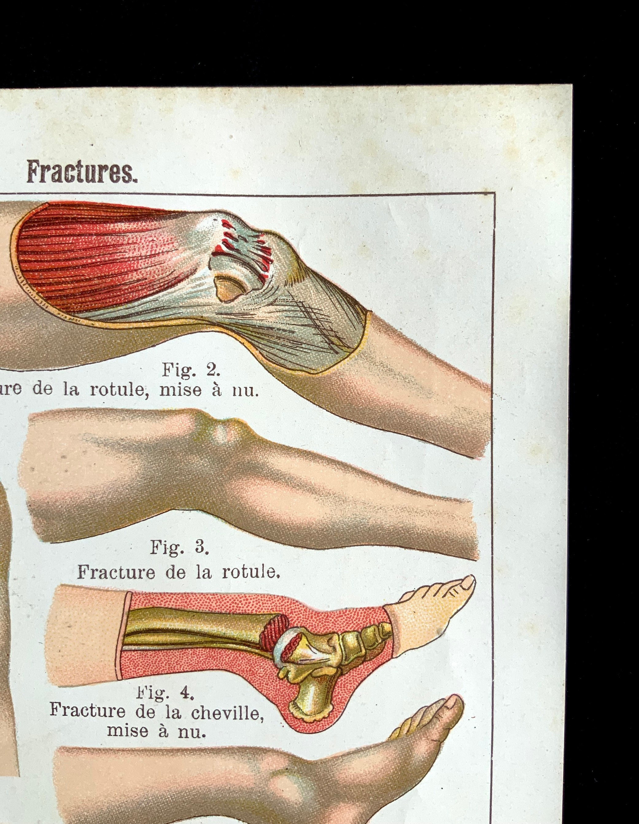 Antique Print French Dissection Anatomy Print Circa 1900 ...