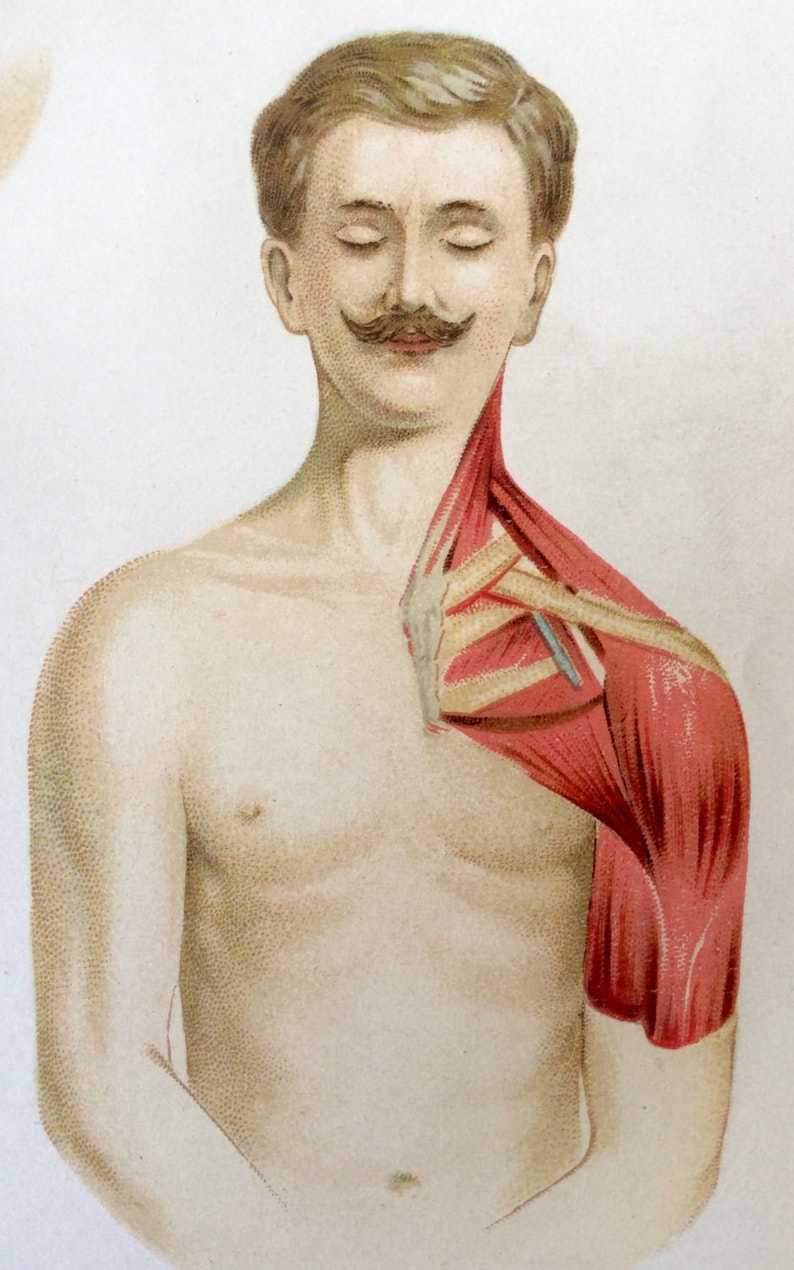 Antique Print 1907 German MUSCLE BONE FRACTURE Medical Chromolithograph ...