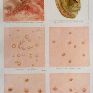 Antique Print Anatomy Bookplate Chromolithograph Small Pox Disease ...