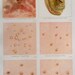 Antique Print Anatomy Bookplate Chromolithograph Small Pox Disease ...