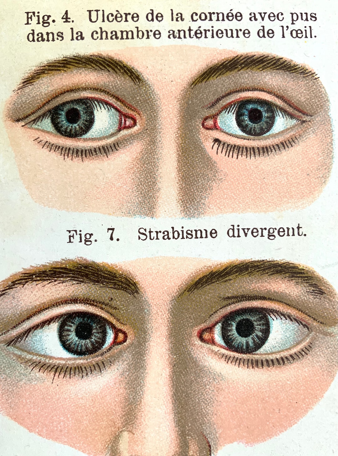 Antique BOSS-EYED Print French Anatomy Bookplate Circa 1900 ...