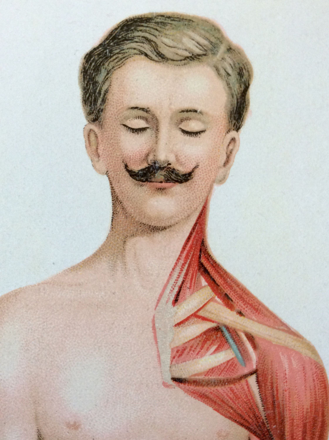 Vintage 1905 German MUSCLE BONE FRACTURE Medical Chromolithograph ...