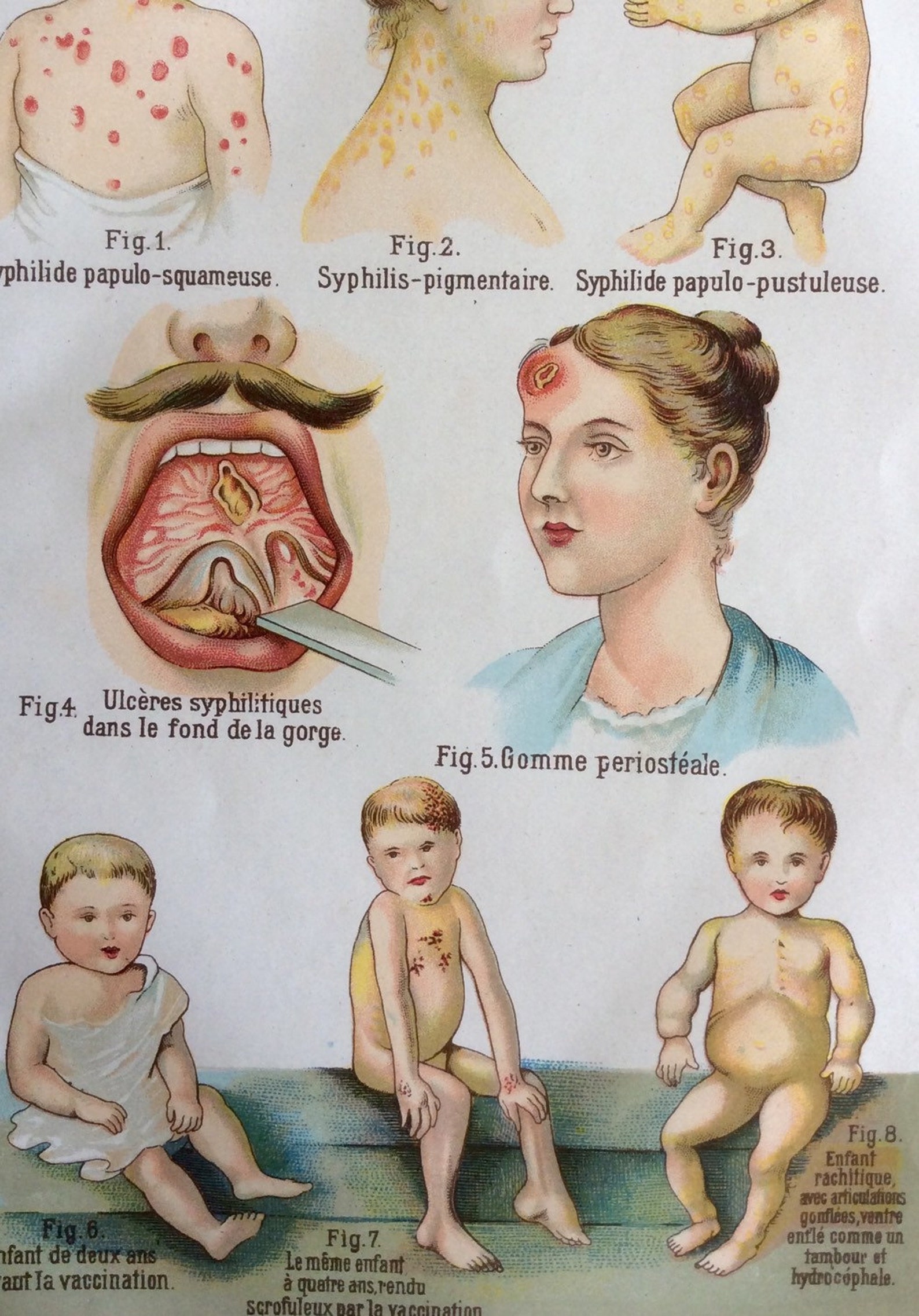 Antique Print French Bookplate Print 1900s Syphilis Chromolithograph Victorian Vintage Medical