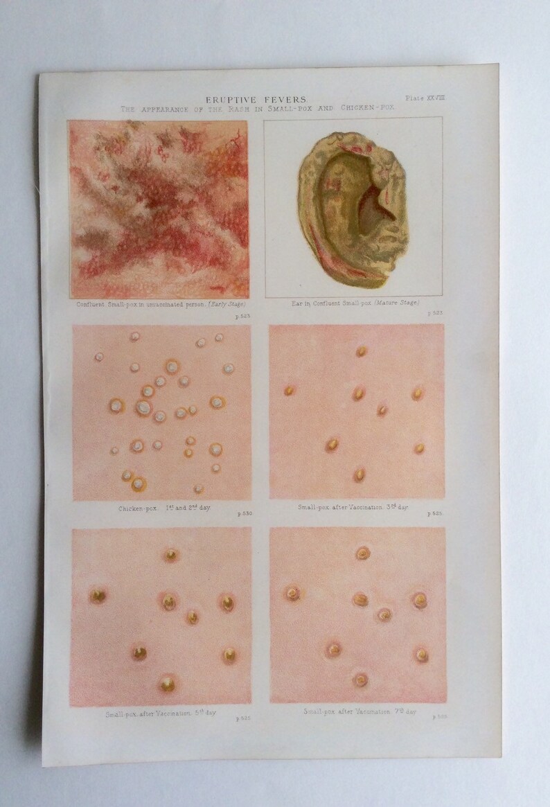 Antique Print Anatomy Bookplate Chromolithograph Small Pox Disease ...