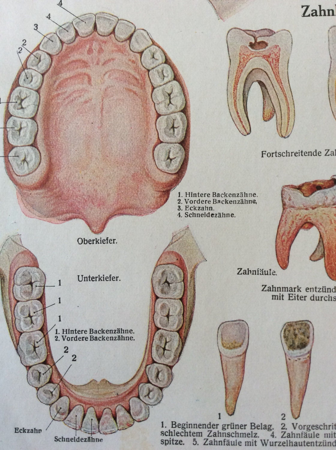 Antique Print 1920s German Anatomy FACE Dissection TOOTH DISEASE Teeth ...