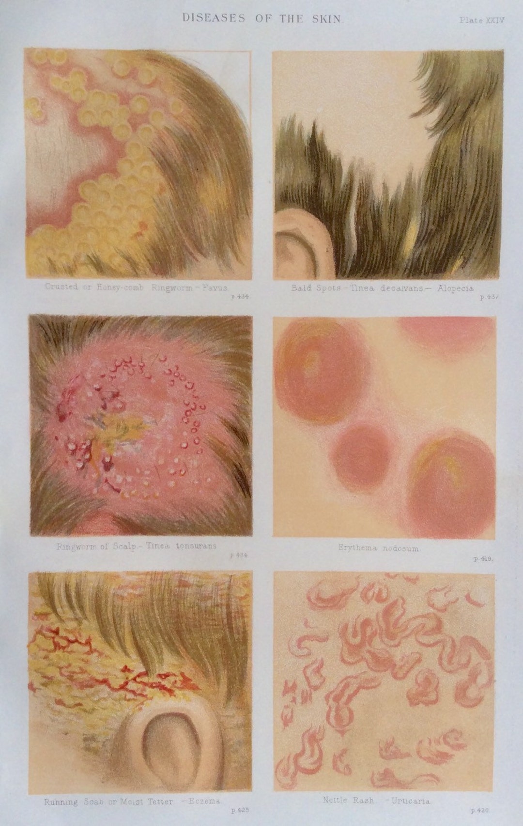 Antique Print Anatomy Bookplate Chromolithograph Rash Spots Scabs Skin ...