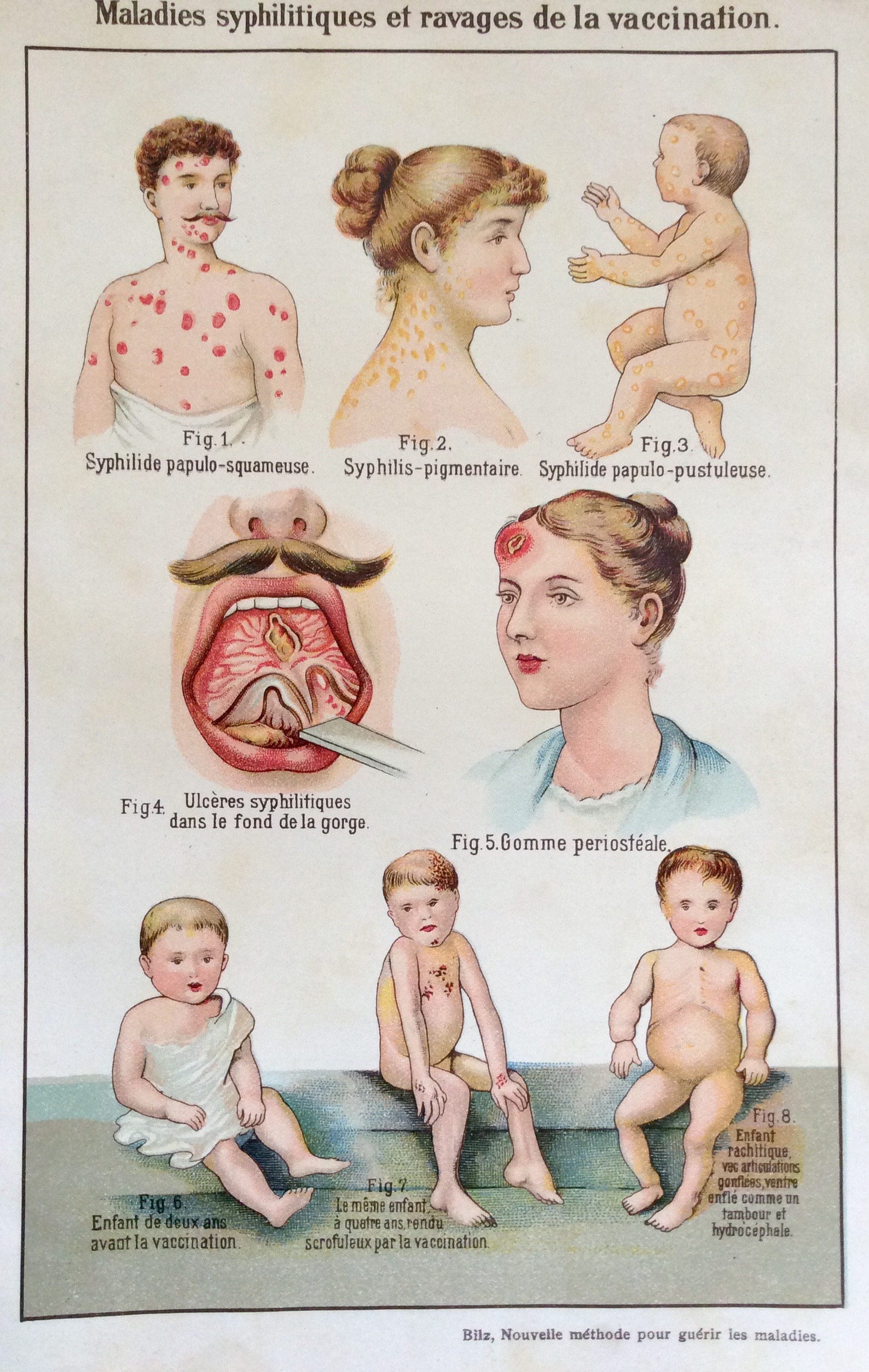 Antique Print French Bookplate 1900s SYPHILIS Chromolithograph ...